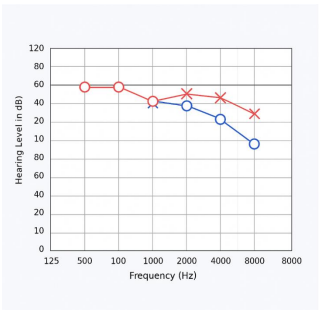 What Is an Audiogram? | Denoc Hearing Test Results Explained